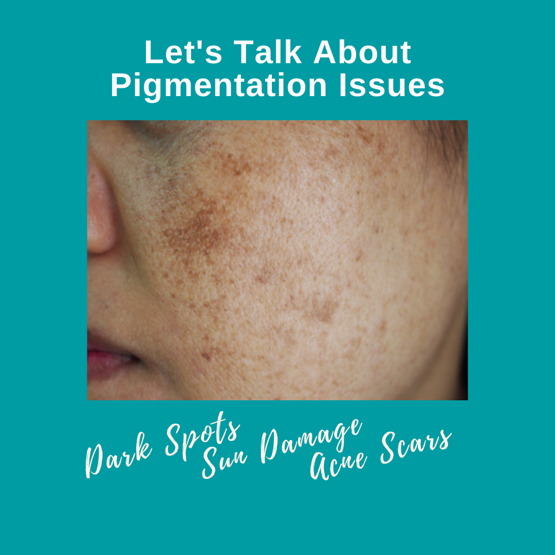 Let's Talk About Pigmentation Issues – Christine Byer Esthetics
