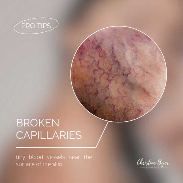 How to Address Broken Capillaries Like a Professional Esthetician ...