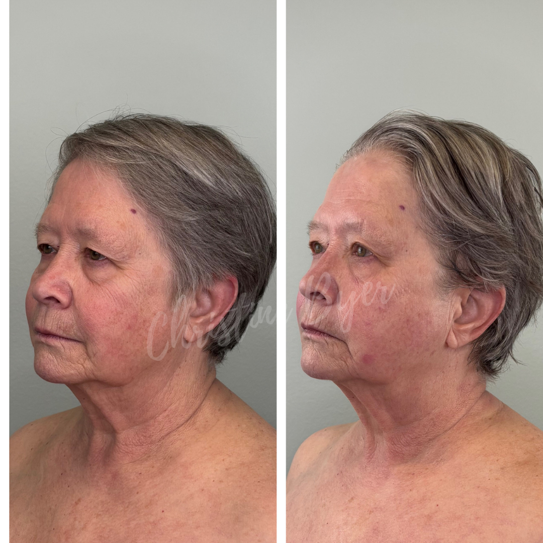 Winter Skin Tightening Secrets: Lift, Hydrate & Glow Without Downtime ...