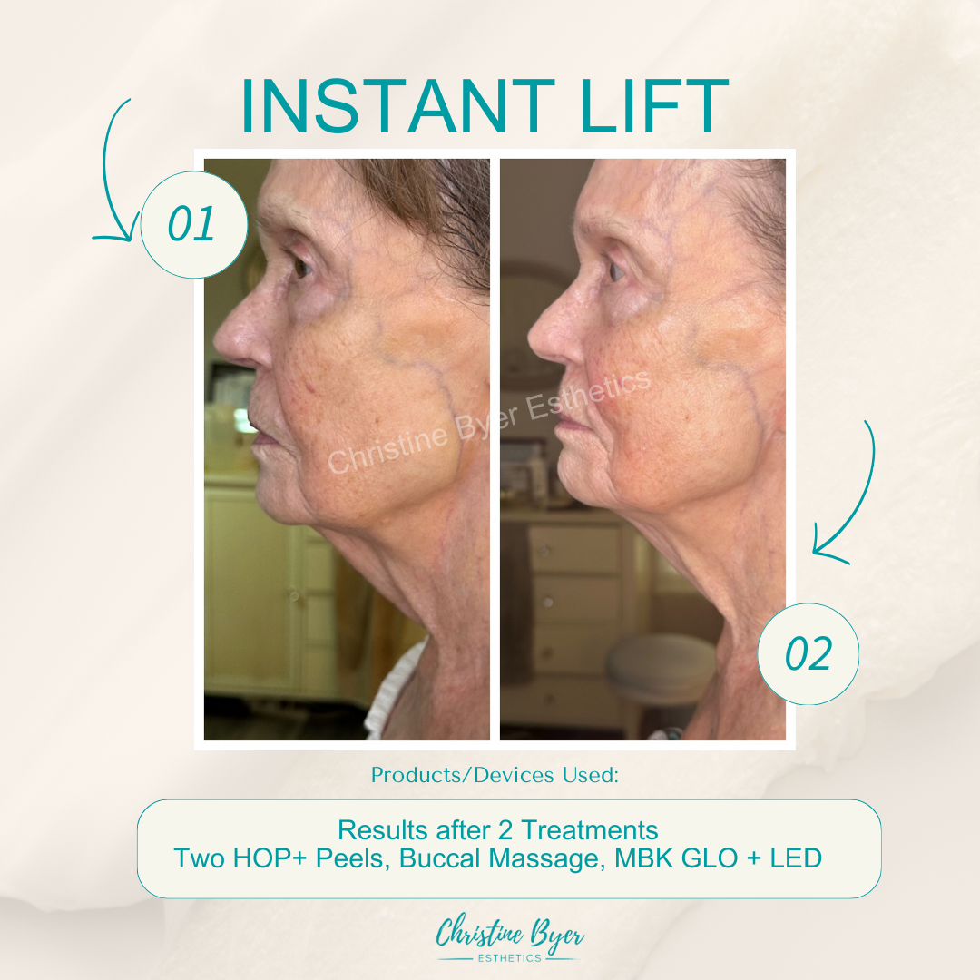 Real Results: Before and After Skin Transformations - Christine Byer ...