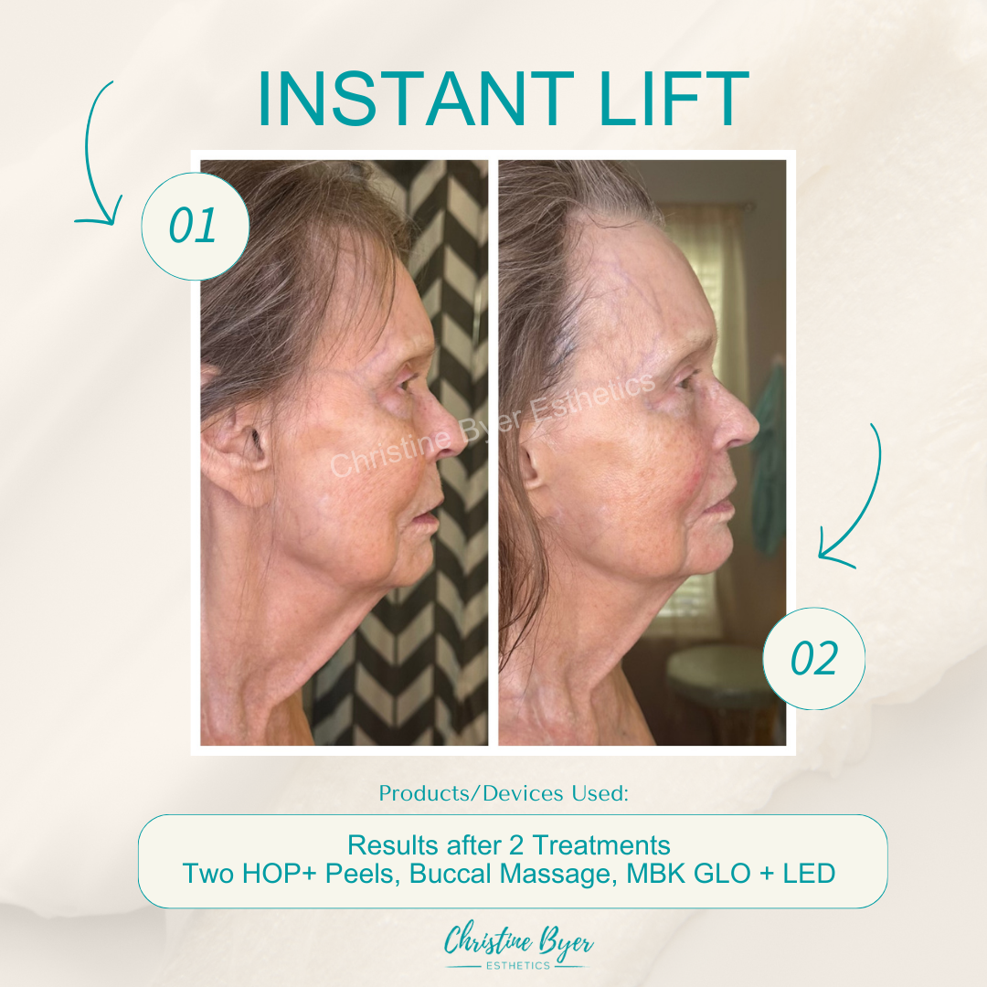 Real Results: Before and After Skin Transformations - Christine Byer ...