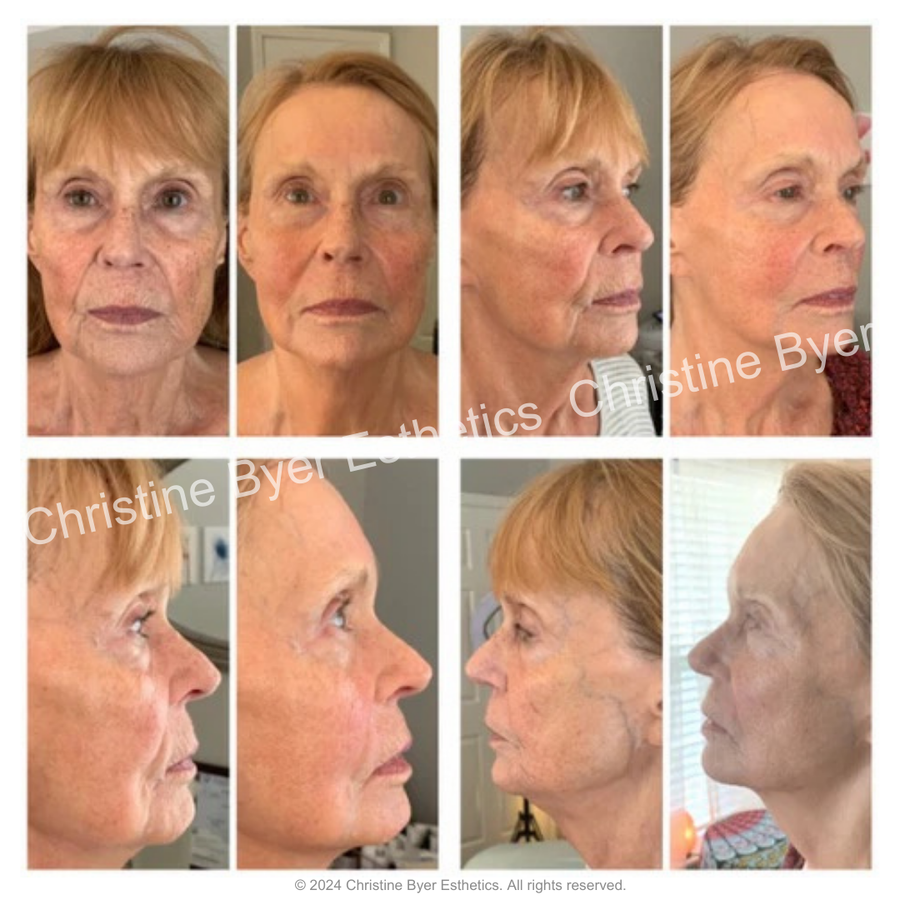 Time Master Pro Ultrasound and LED-2024 MODEL – Christine Byer Esthetics