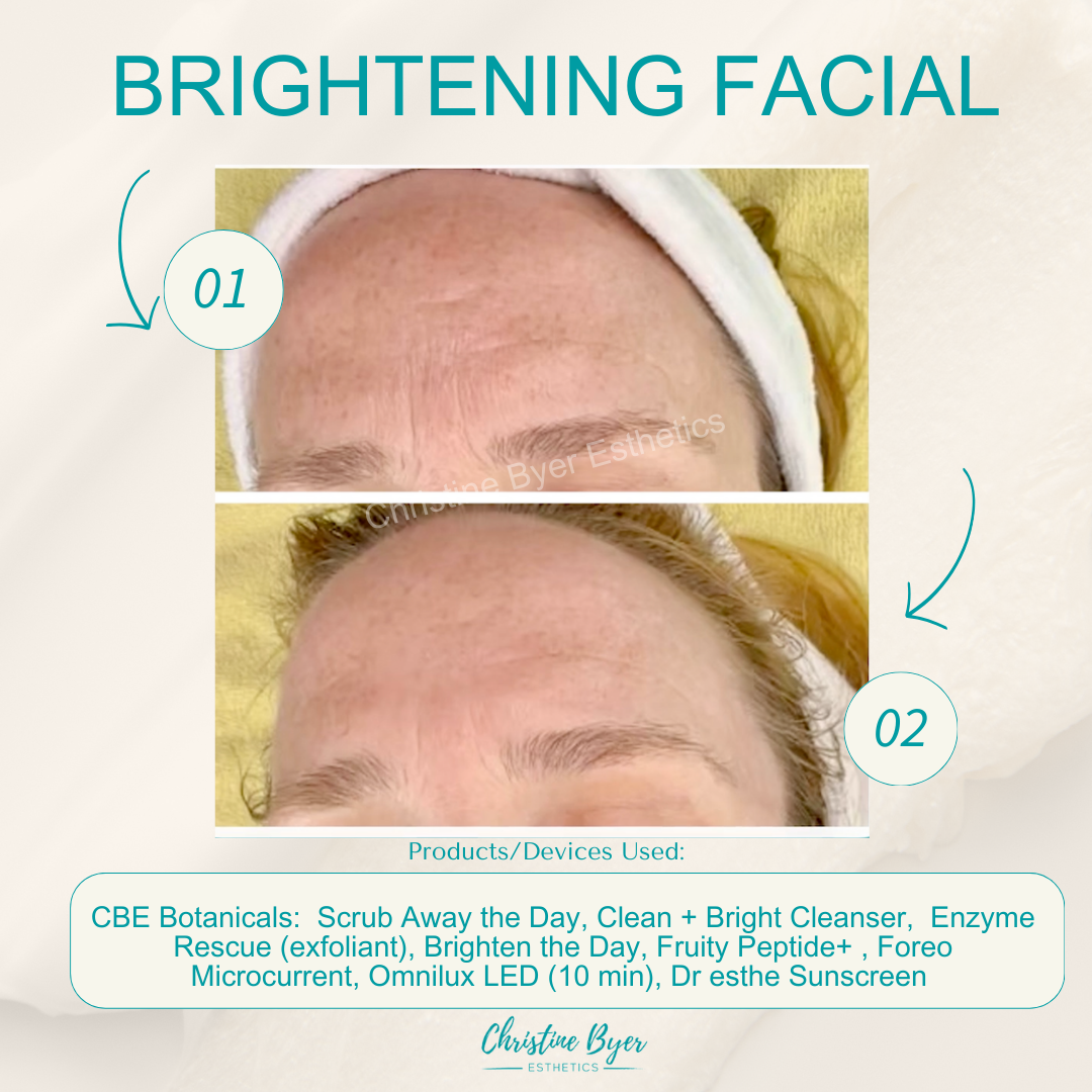 Real Results: Before and After Skin Transformations - Christine Byer ...